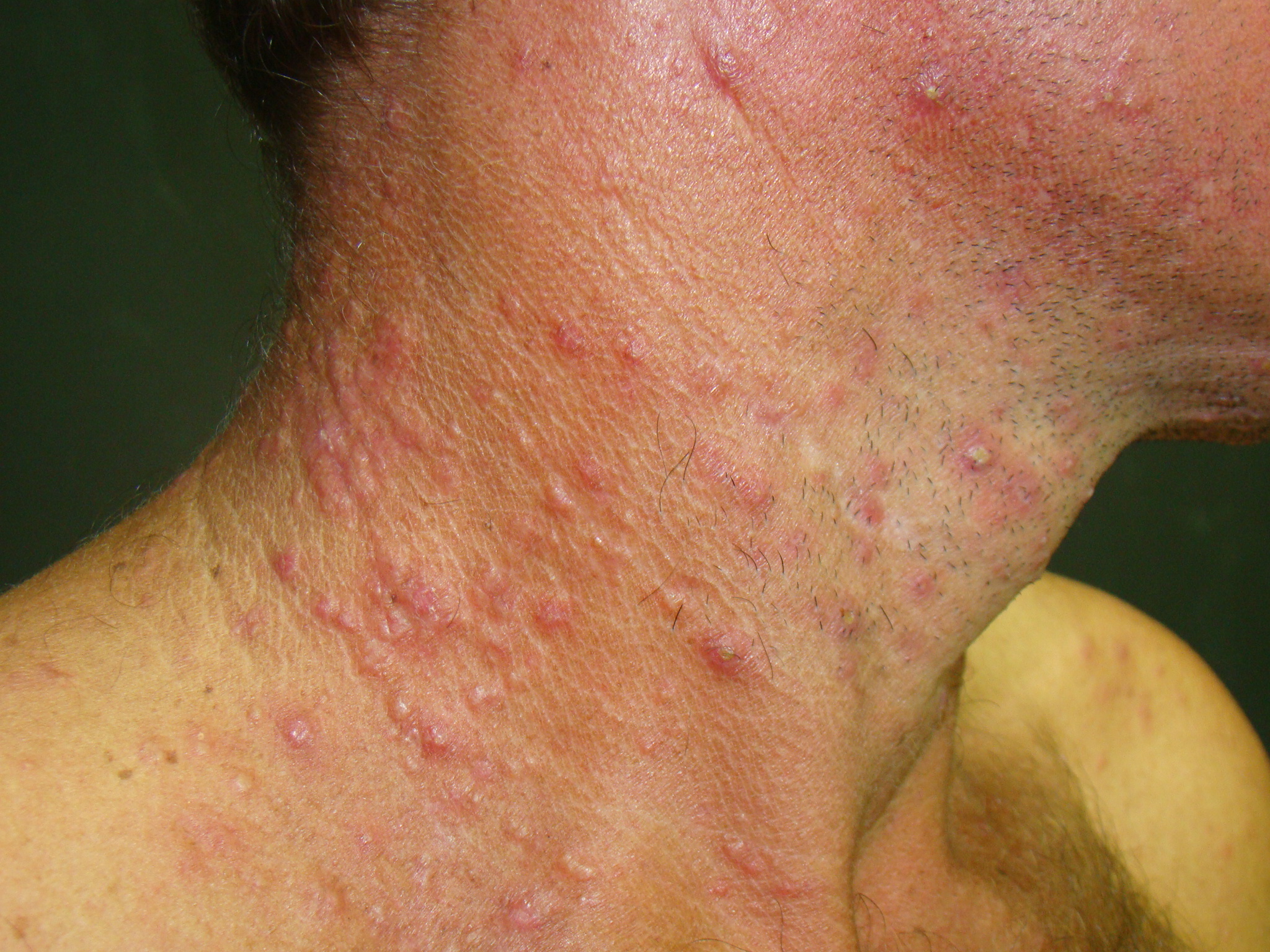Cuidado com a Sífilis: Epidemia atinge BR e também no RN • Brechando